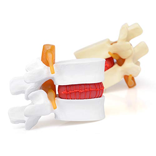 Anatomical Herniated Lumbar Vertebrae Disc Prolapse Model Human Medical Anatomy