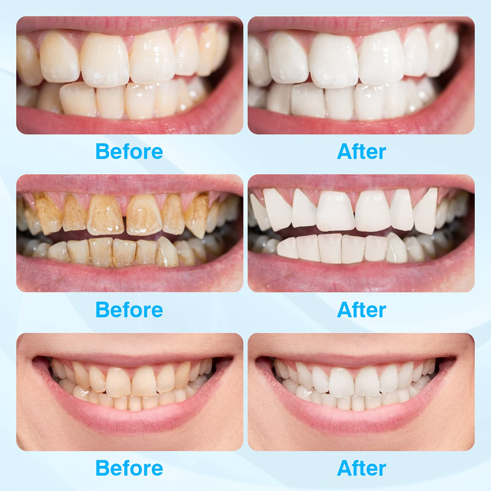 Teeth Whitening Kit Tooth Whitener - DOUCEUR Dental Bleaching System Professional with 16X LED Mouth Tray Light 5Pcs Whiting Gel Pen for Purely Whitening of Sensitive Teeth