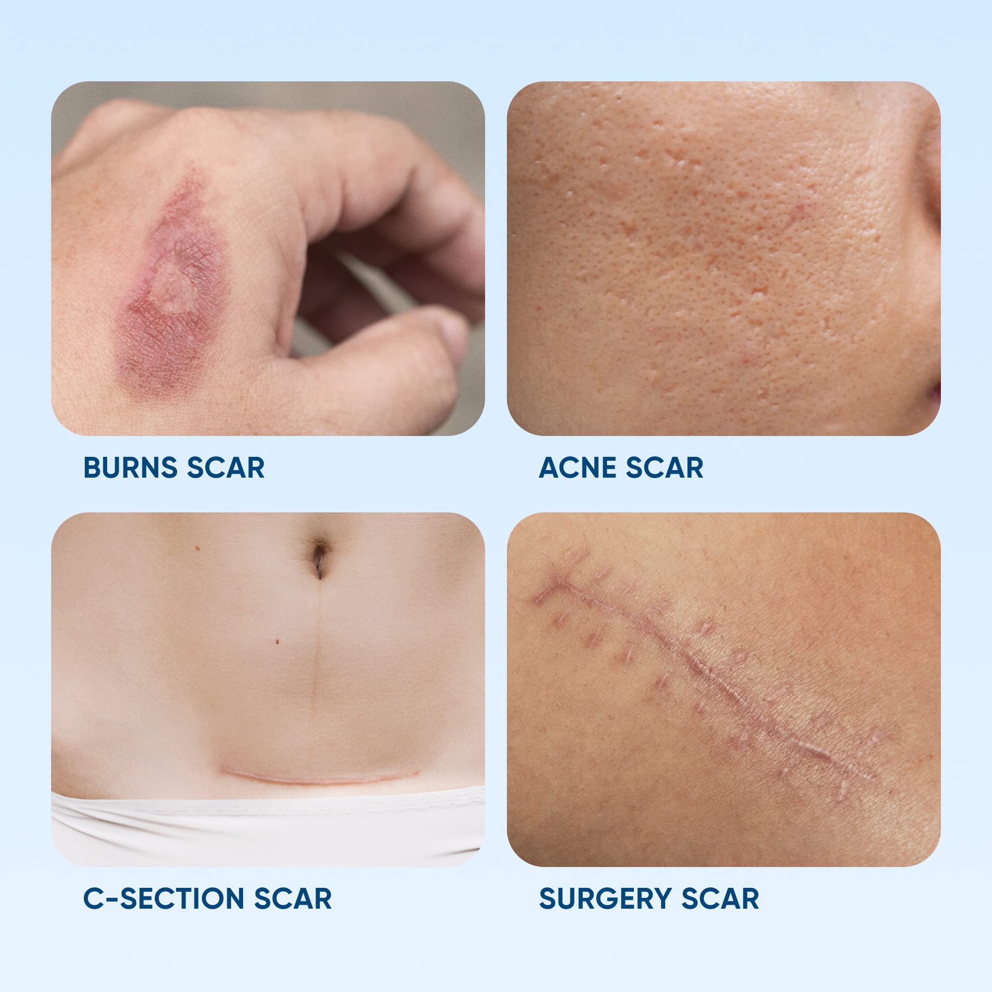 Silicone Scar Removal Sheets - Breathable Reusable & Waterproof Keloid Scar Removal Patches Caused by C-Section, Surgery, Burn, Acne, Stretch Marks Healing Alternative to Gel, Tape & Cream (4 sheets)