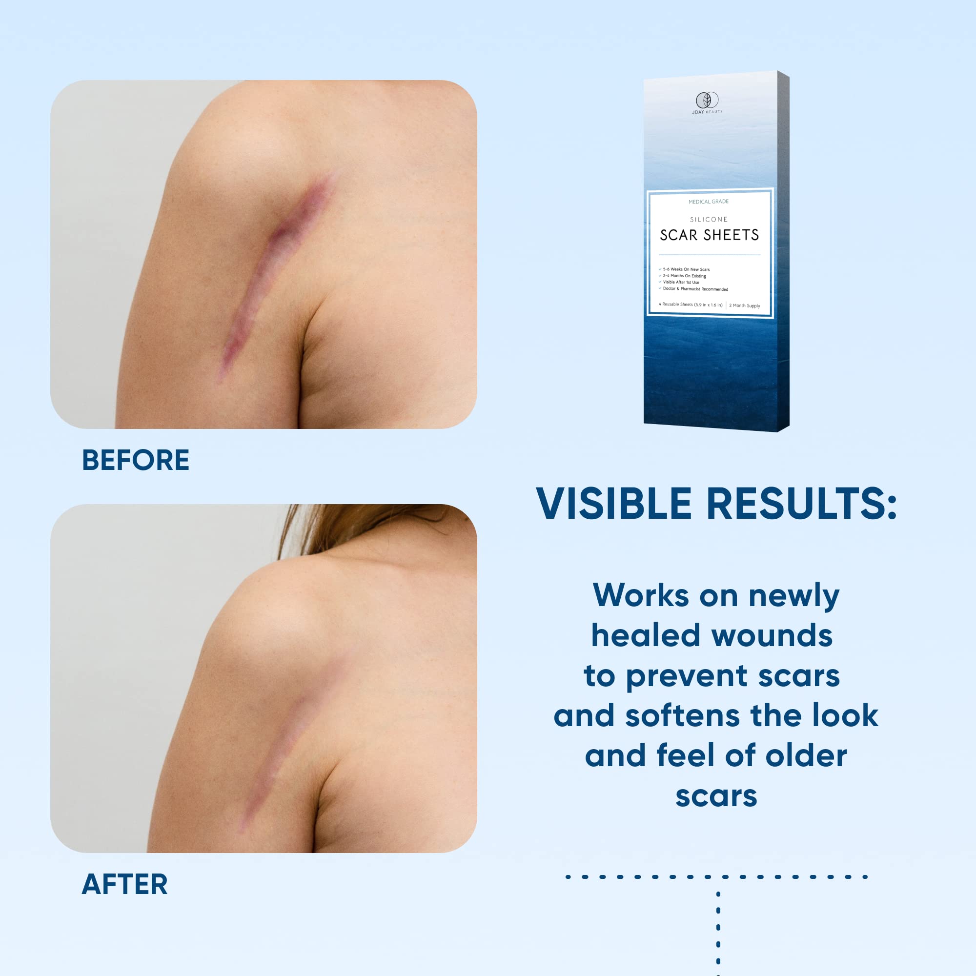 Silicone Scar Removal Sheets - Breathable Reusable & Waterproof Keloid Scar Removal Patches Caused by C-Section, Surgery, Burn, Acne, Stretch Marks Healing Alternative to Gel, Tape & Cream (4 sheets)