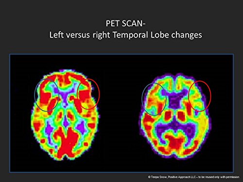 "Understanding Frontotemporal Dementias (FTDs)" 2-DVD Set with Dementia Trainer Teepa Snow