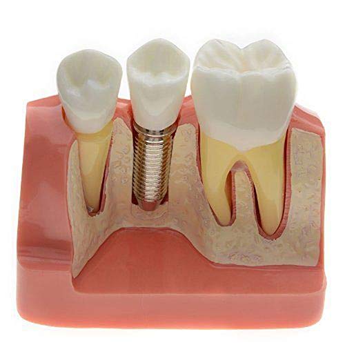 1 PCS Dental Model Implant Analysis Crown Bridge Demonstration Teeth Model for Education