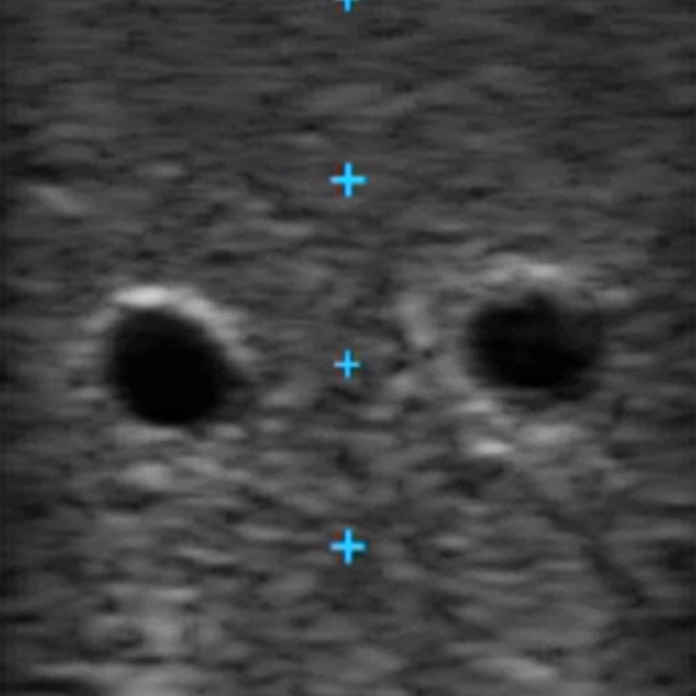 0705 - Vascular Access Ultrasound Phantom, Lightly pigmented