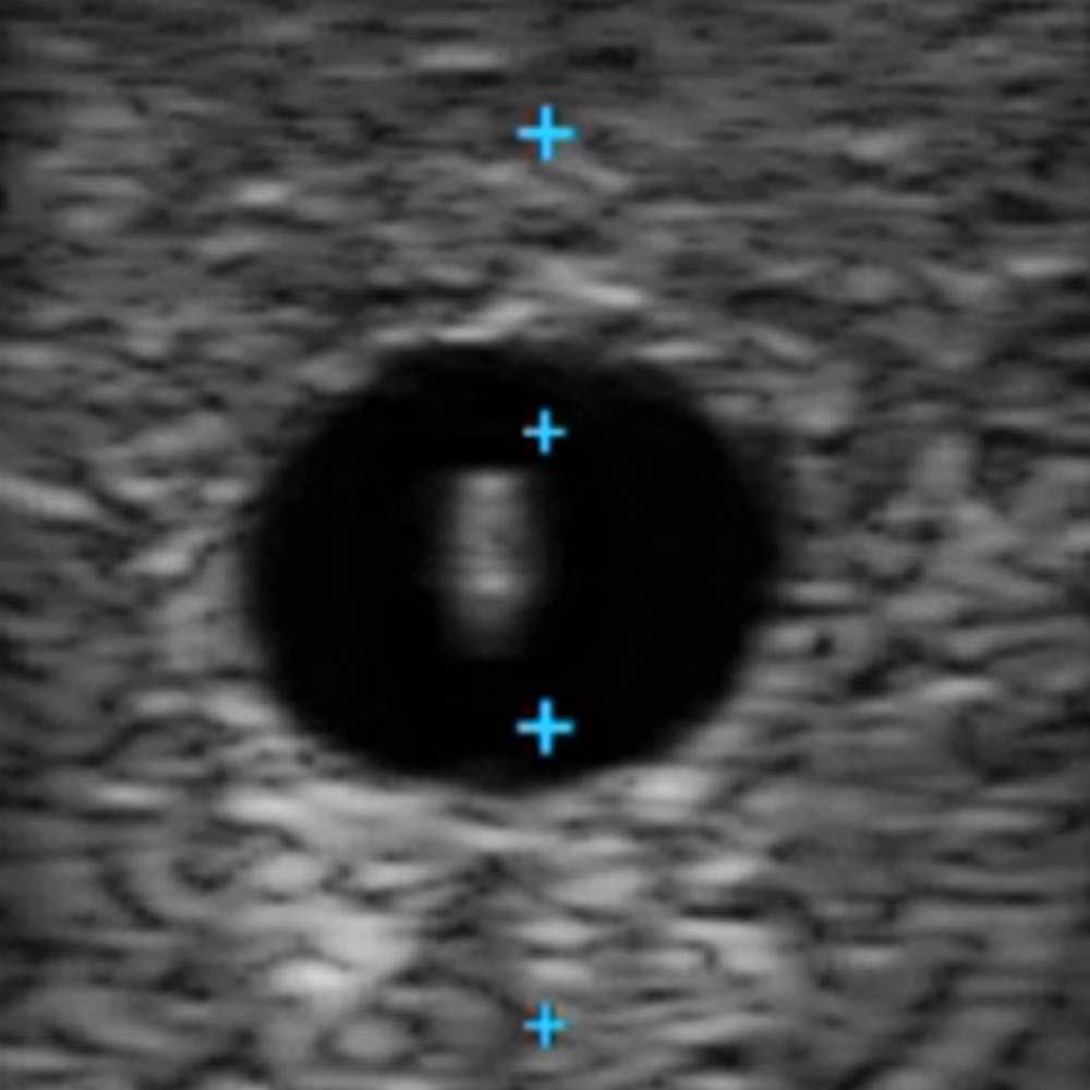 0705 - Vascular Access Ultrasound Phantom, Lightly pigmented