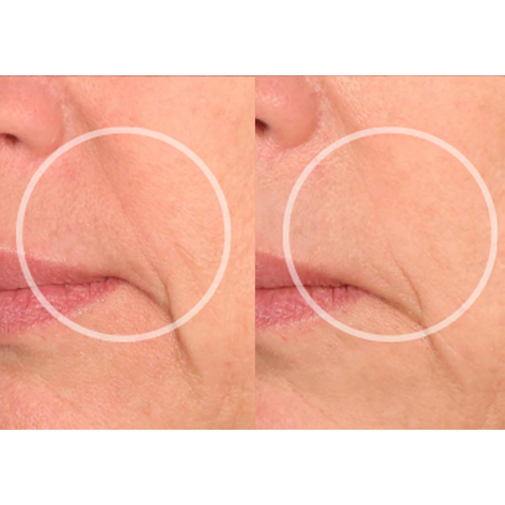 SiO Beauty Eye & Smile Lift - Eye & Smile Anti-Wrinkle Patches 2 Week Supply - Overnight Smoothing Silicone Patches for Wrinkles and Fine Lines