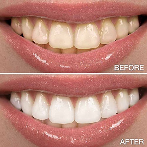 XL Teeth Whitening Pen 4cc (not 2cc) with 20+ uses of 22% Carbamide Peroxide Tooth Whitener Stain Remover Gel. Natural Mint, no Sensitivity, Made in The USA.