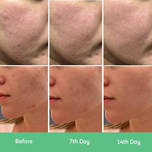Azani 10% Lactic Acid + Squalane Resurfacing - 1.01 Oz Serum | Face Exfoliating AHA to Soften and Smooth Skin, Brighten Complexion and Diminish Fine Lines & Wrinkles - Women & Men