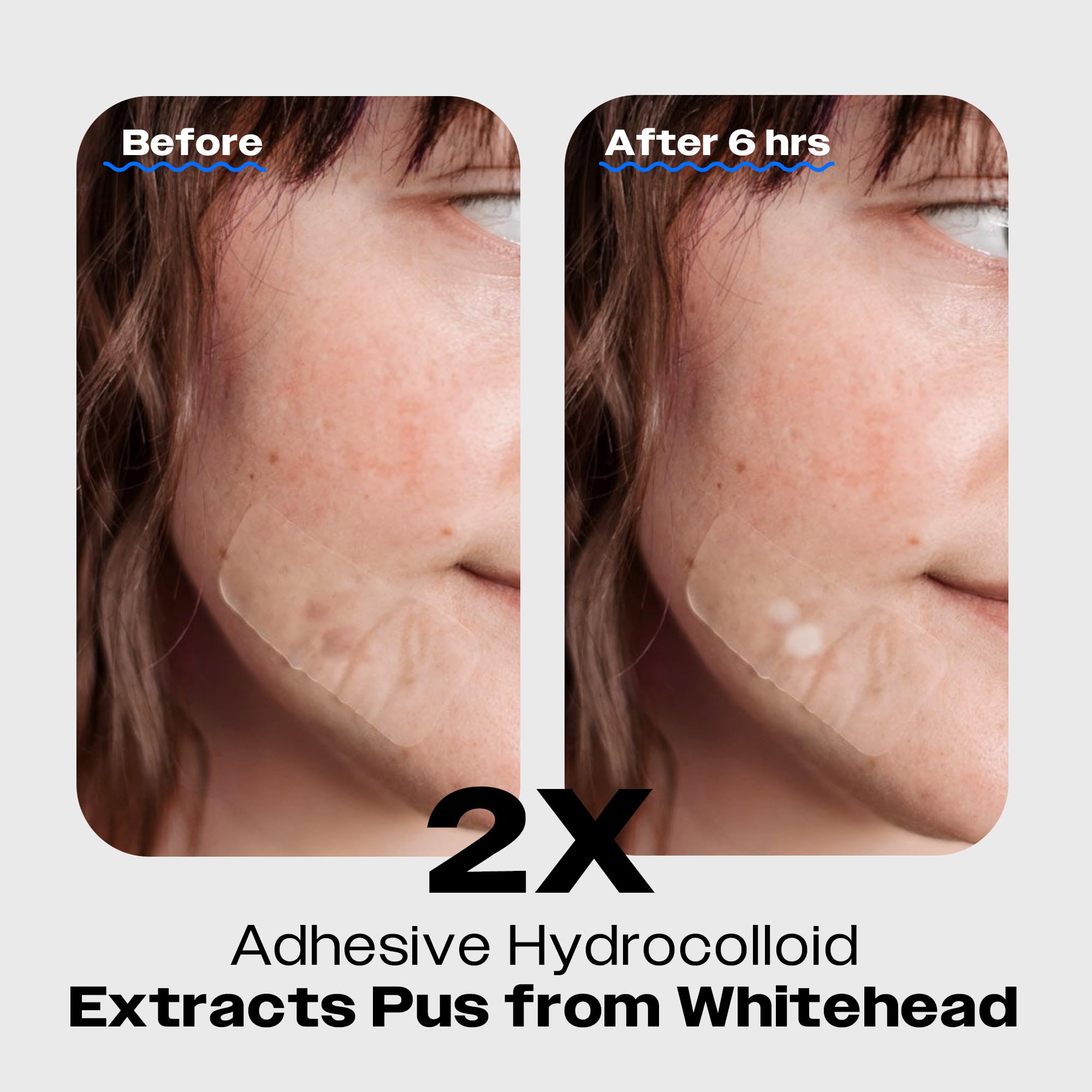 AVARELLE ZITOUT Large Hydrocolloid Pimple Strips (16 Patches) | Vegan Nose Patches for Pores Tea Tree | Chin Acne Patches for Face | Hydrocolloid Bandages for Acne | FSA & HSA Acne Treatment