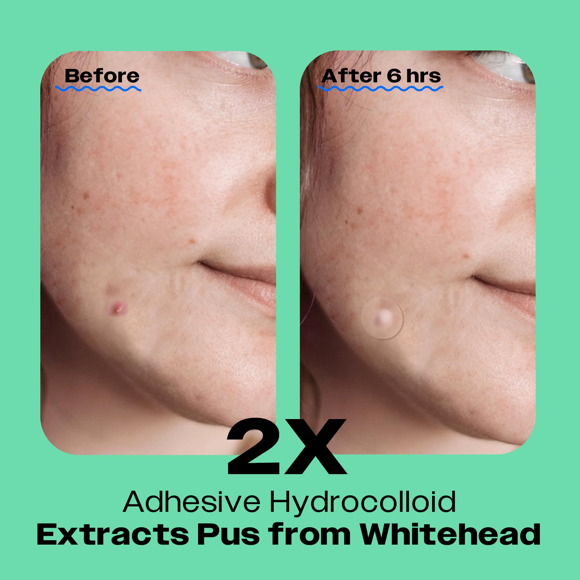 Avarelle Acne Pimple Patch (40 Count) Absorbing Hydrocolloid Spot Treatment with Tea Tree Oil, Calendula Oil and Cica, Certified Vegan, Cruelty Free (VARIETY / 40 COUNT)