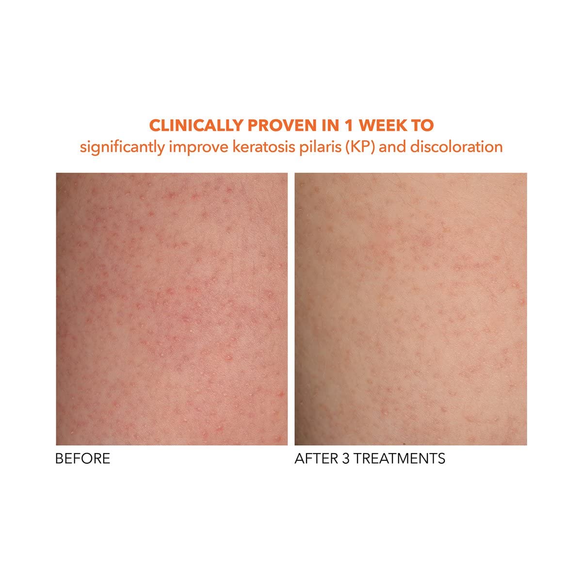 Dr Dennis Gross Alpha Beta Exfoliating Body Treatment | Multi-Tasking Powered by AHA/BHAs for Smooth, Hydrated Skin While Improving Ingrown Hairs, Keratosis Pilaris, and Blemishes | 8 Textured Towels