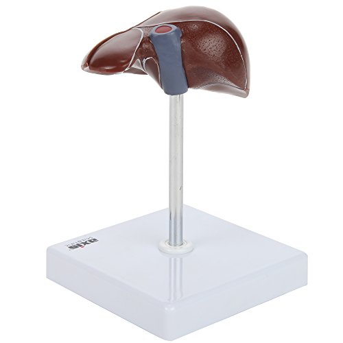 Axis Scientific Anatomy Model of Diseased Liver | Model is 1/3 Life-Size and Divides in 2 Parts | Shows 6 Liver Diseases and Abnormalities | Comes on a White Base