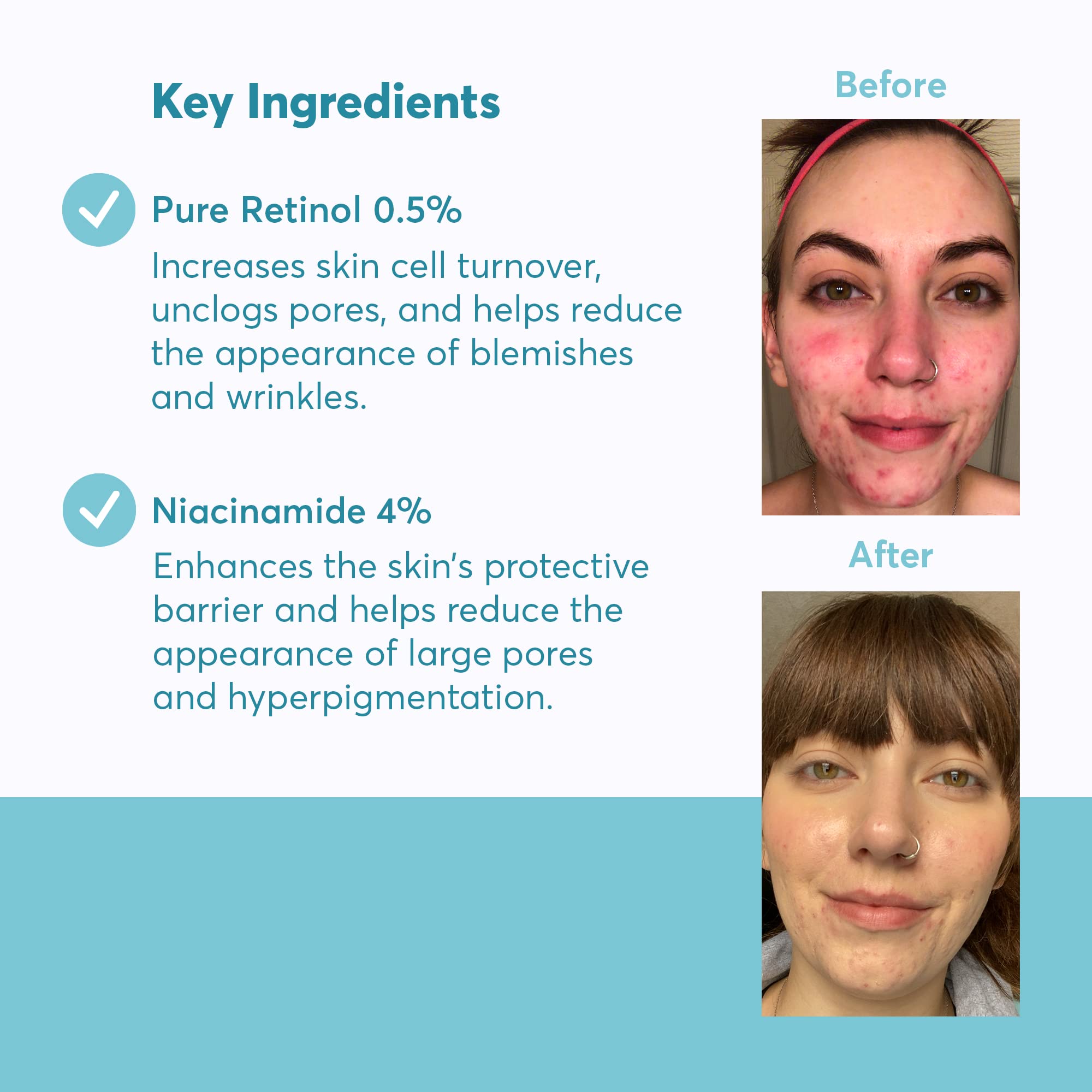 MDacne β Retinol 0.5% and Niacinamide 4% Cream, Reduces Blemishes and Improves Skin Texture without Irritation
