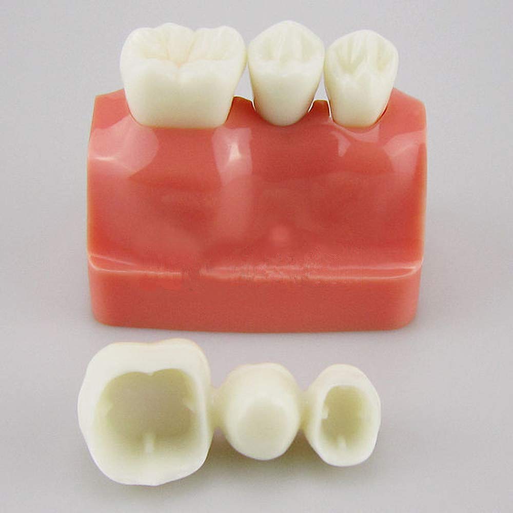 Analysis Model for Dental Implant Crown Bridge Demonstration Teeth Model for Education M2017