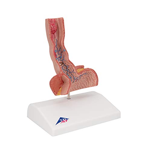 3B Scientific K18 Illnesses of the Esophagus - 3B Smart Anatomy