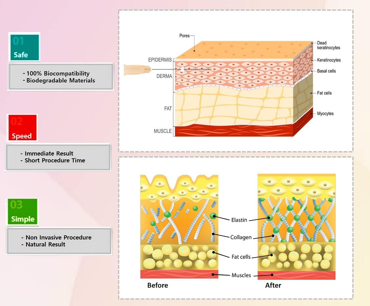 ACE - Multi Thread/L Cannular PDO thread for Forehead/Nose/Nasolabial Folds (23G38/50mm)