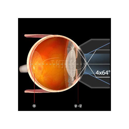 Volk G-4 Gonio Lens - Numerous Contact Type, Handle and Ring Size Options (G-4 High Mag Gonio, No Flange, Small Ring)