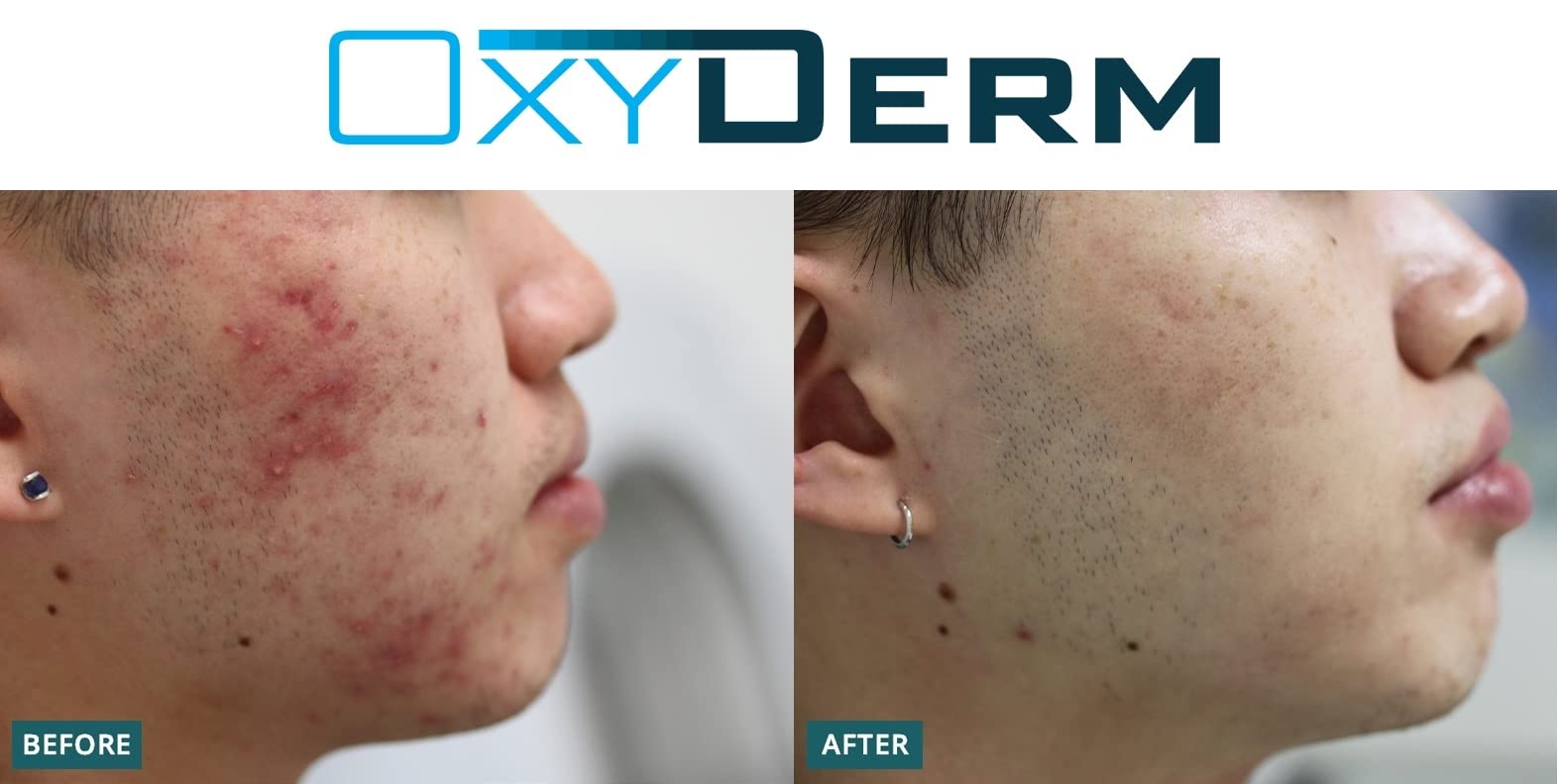 Acne Clearing Treatment Pads- Eliminates Acne Breakout Causing Bacteria. Clear Away Clogged Pores, Oily Skin, Blemish, Blackhead, Pimple, Cystic Breakouts. Contains Salicylic, Glycolic & Lactic Acid.