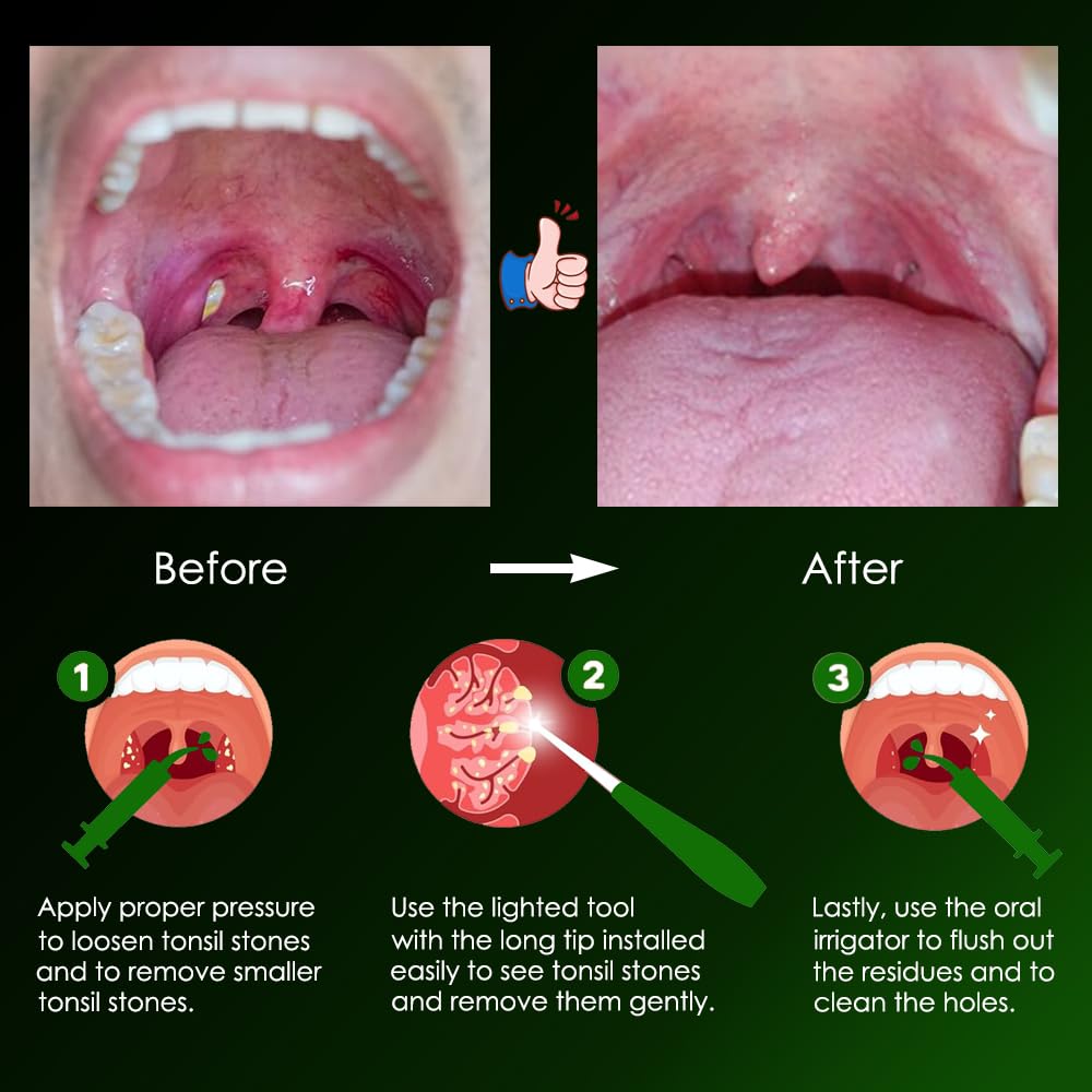 Airgoesin Upgraded 2 Lighted Tonsil Stone Remove Tool Tonsillolith Pick + Irrigation Clean Syringe Fresh Breath Oral Rinse