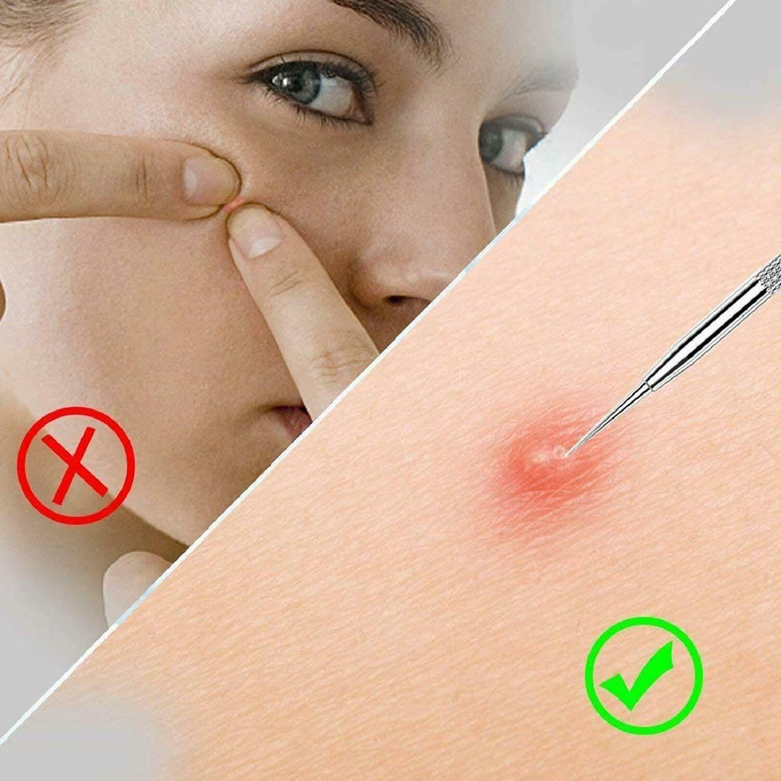 Blackhead Remover Pimple Comedone Extractor Tool Acne Kit - Treatment for Blemish, Whitehead Popping, Zit Removing for Risk Free Nose Face Skin (Sliver)