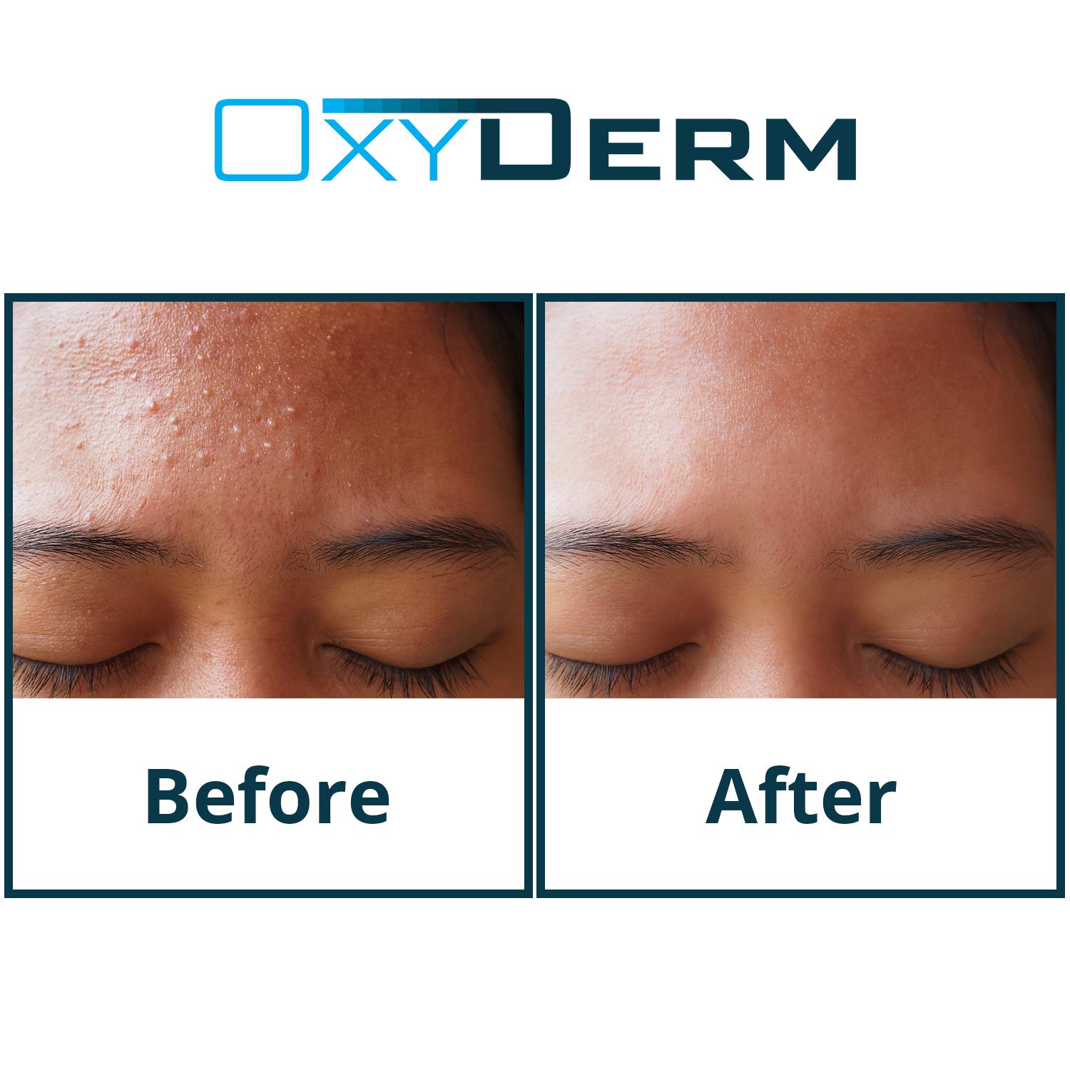 Acne Clearing Treatment Pads- Eliminates Acne Breakout Causing Bacteria. Clear Away Clogged Pores, Oily Skin, Blemish, Blackhead, Pimple, Cystic Breakouts. Contains Salicylic, Glycolic & Lactic Acid.
