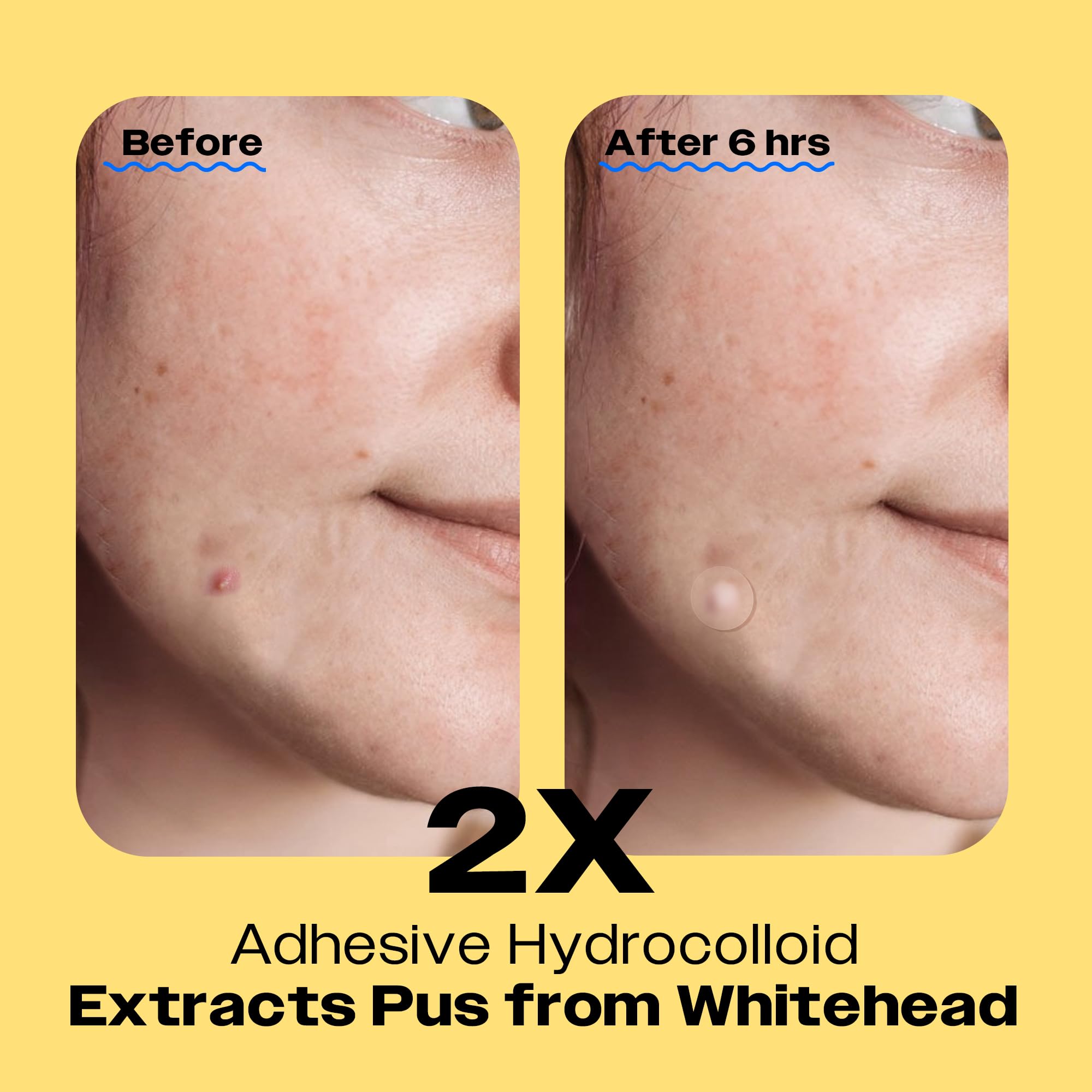 AVARELLE Invisible Acne Spot Patch (24 Count) Ultra Thin Hydrocolloid Spot Sticker for Day Time Acne l For Covering Zits & Blemish with Calendula, Rosehip Seed, Vegan, Cruelty Free