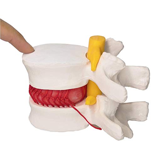 Human Herniated Disc Model, Anatomical Herniated Lumbar Vertebrae Disc Prolapse Model for Medical Teaching Learning, Education Display Tooling, Kids Learning Education Display Tool 2 Pack