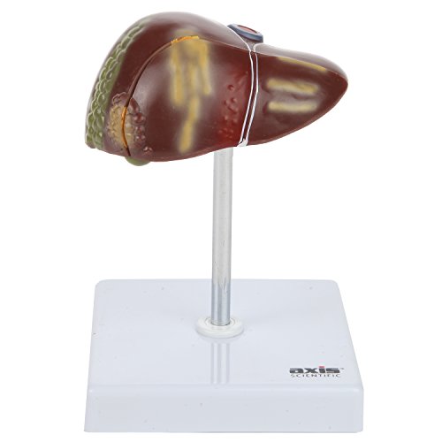 Axis Scientific Anatomy Model of Diseased Liver | Model is 1/3 Life-Size and Divides in 2 Parts | Shows 6 Liver Diseases and Abnormalities | Comes on a White Base