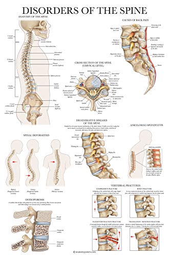 Palace Learning 2 Pack: Anatomy of the Spine + Disorders of the Spine Poster Set - Set of 2 Anatomical Charts - Laminated - 18" x 24"