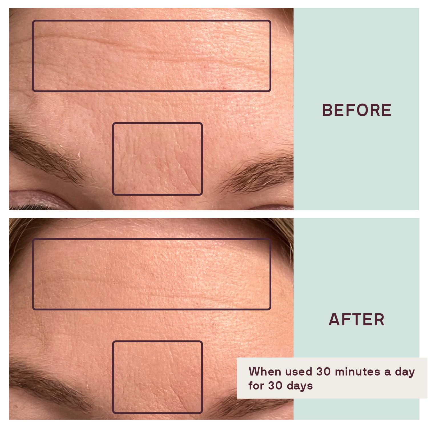 Dermaclara Forehead Patch - Forehead Wrinkle Patches for Face Overnight, Silicone Patches, Reusable Treatment for Wrinkles, Repair & Restore, Up to 30 Uses - 1 Patch