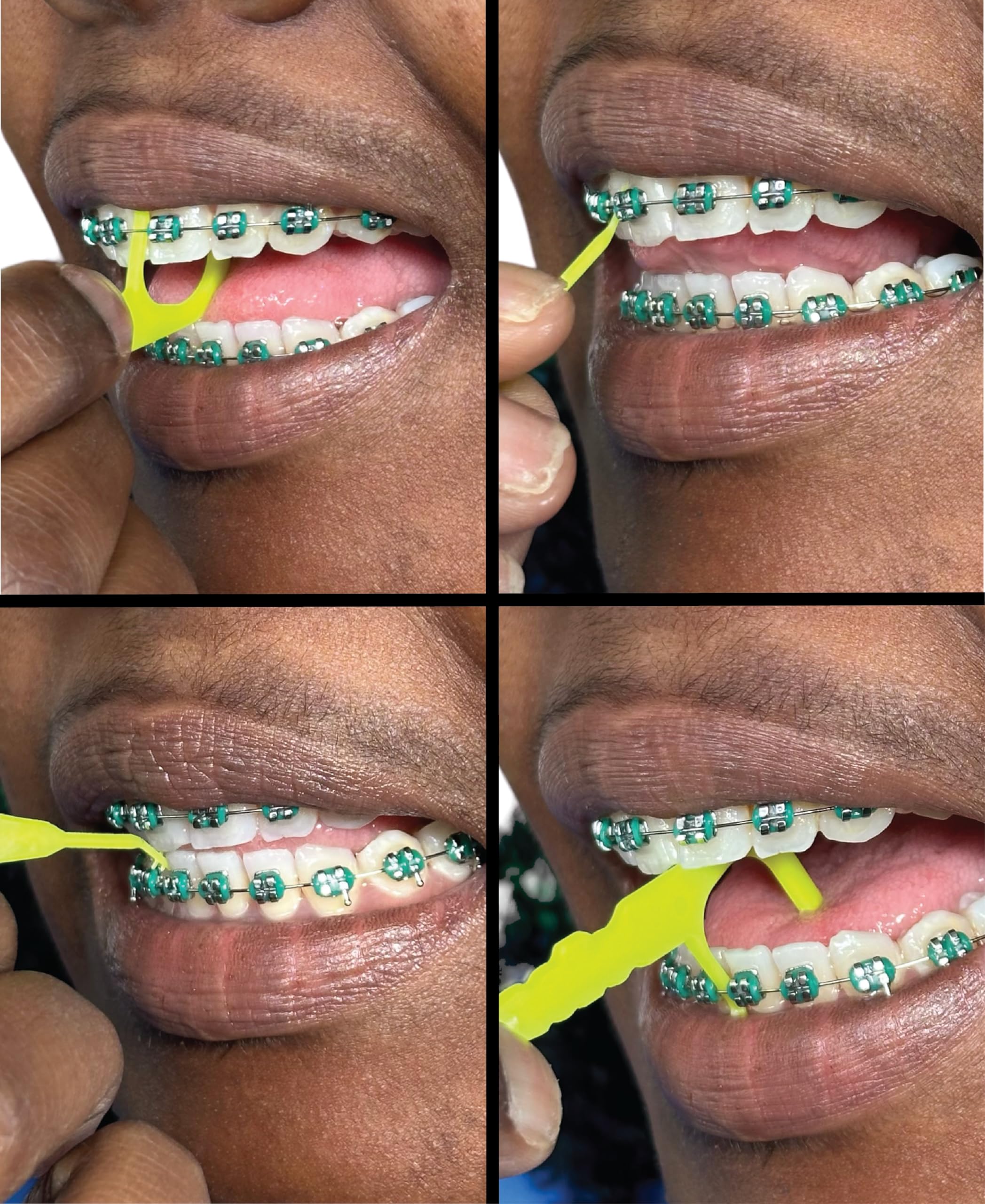 LBailar Braces Toothbrush Rechargeable with 4 Heads Bonus 2 AFTERCARE