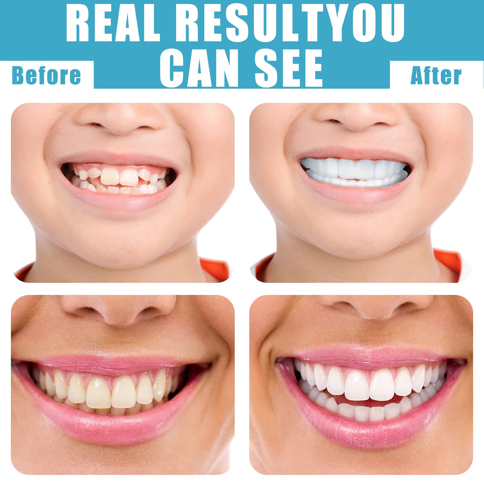2 Set Fake Teeth Denture Teeth Veneer Snap in Teeth Confidence Smile Dentures Veneer Fake White Teeth with 2 Pieces Mini Tweezers for Halloween Men and Women Bad Teeth Whitening Alternative