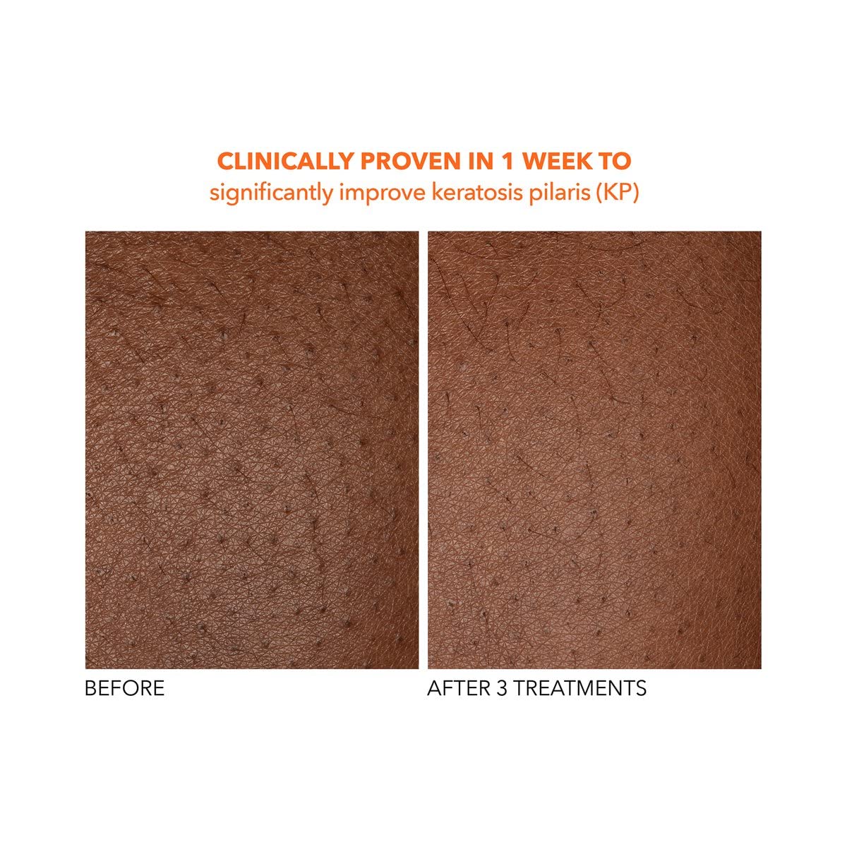Dr Dennis Gross Alpha Beta Exfoliating Body Treatment | Multi-Tasking Powered by AHA/BHAs for Smooth, Hydrated Skin While Improving Ingrown Hairs, Keratosis Pilaris, and Blemishes | 8 Textured Towels