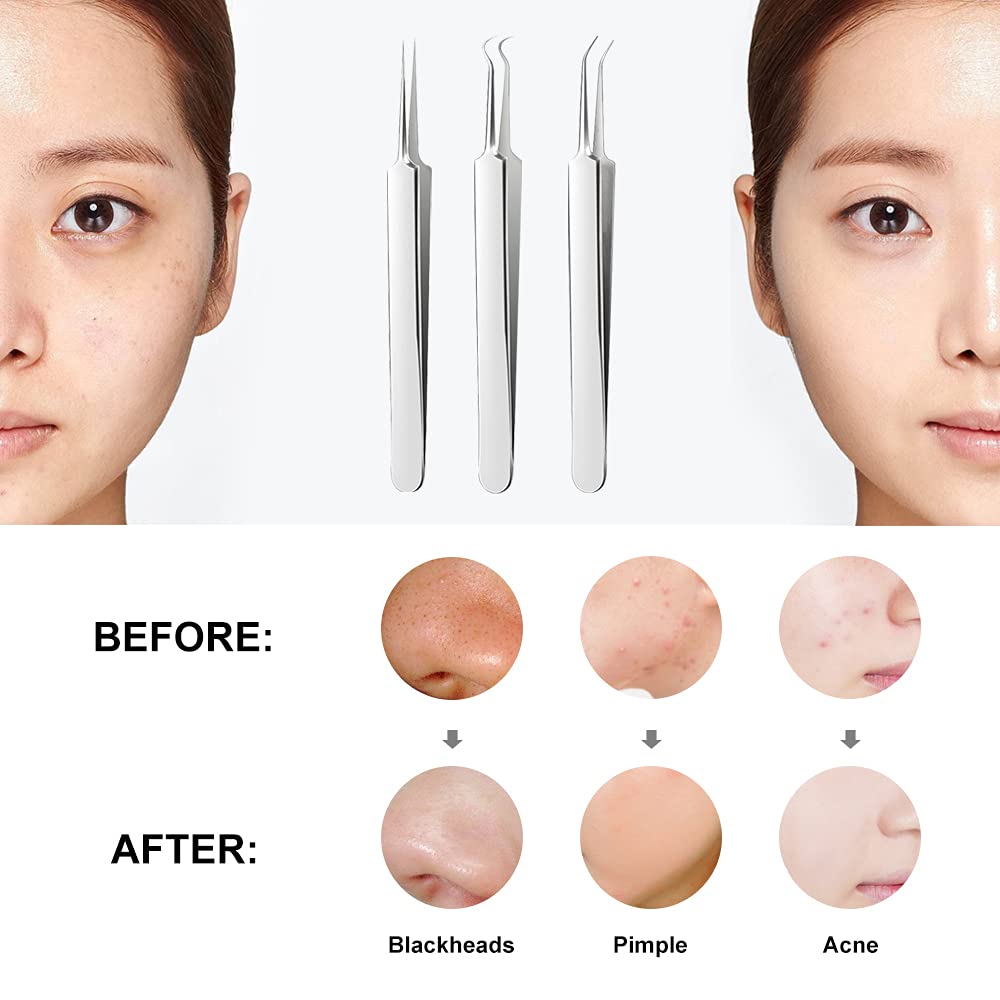 La Chat Blackhead Remover Kit - Blackhead Tweezers Removal Tool 3 pcs Comedone Pimple Extractor Tool, Acne Blemish Kit for Blackhead, pimple Tool, Curved Blackhead Tweezers kit (3 pcs)