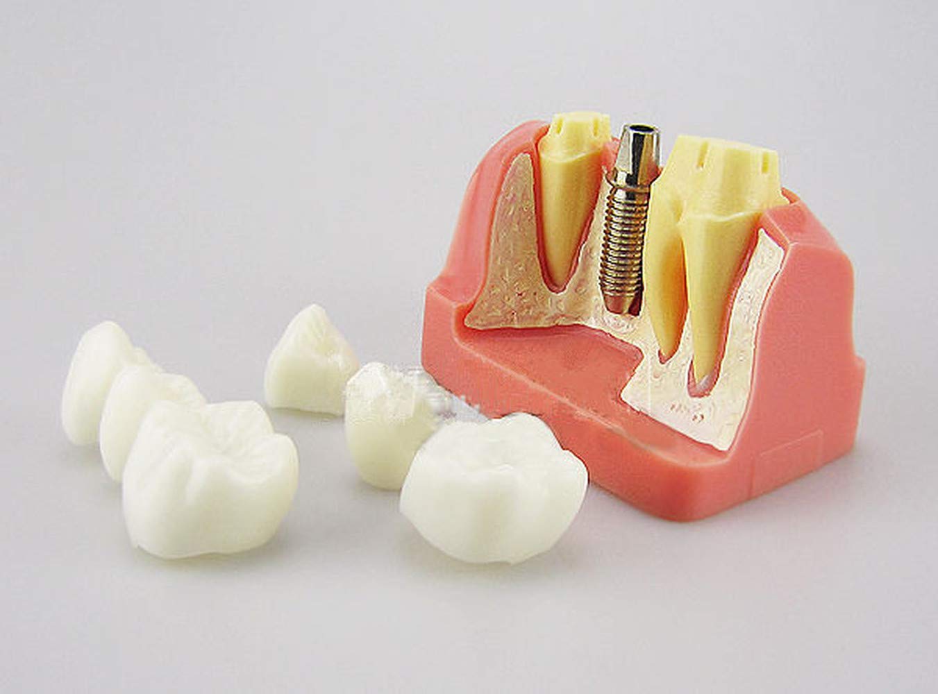 Analysis Model for Dental Implant Crown Bridge Demonstration Teeth Model for Education M2017