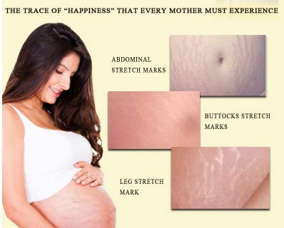 1pcs Remove Stretch Marks Cream Anti Wrinkle Anti Aging Maternity Skin Repair Remove Pregnancy Scars Treatment Body Skin Care