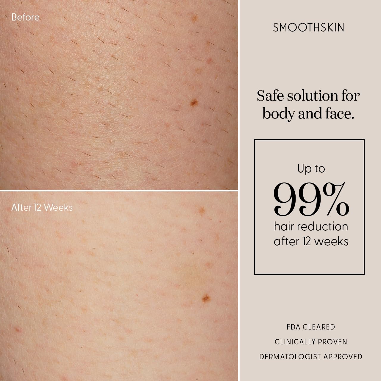 Smoothskin Pure IPL Laser Hair Removal Device for Women & Men, Long-Lasting, for Body, Bikini & Face, Alternative to Laser & Bikini Shaver