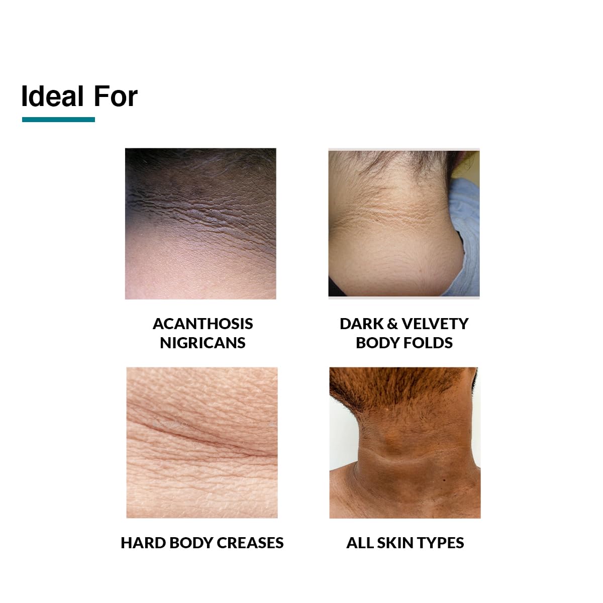 FIXDERMA Nigrifix Cream for Acanthosis Nigricans with Lactic Acid | Dermatologist Tested Retinol Cream | Useful for Dark Body Parts like Neck, Ankles, Armpits & Elbows –3.52 FlOz