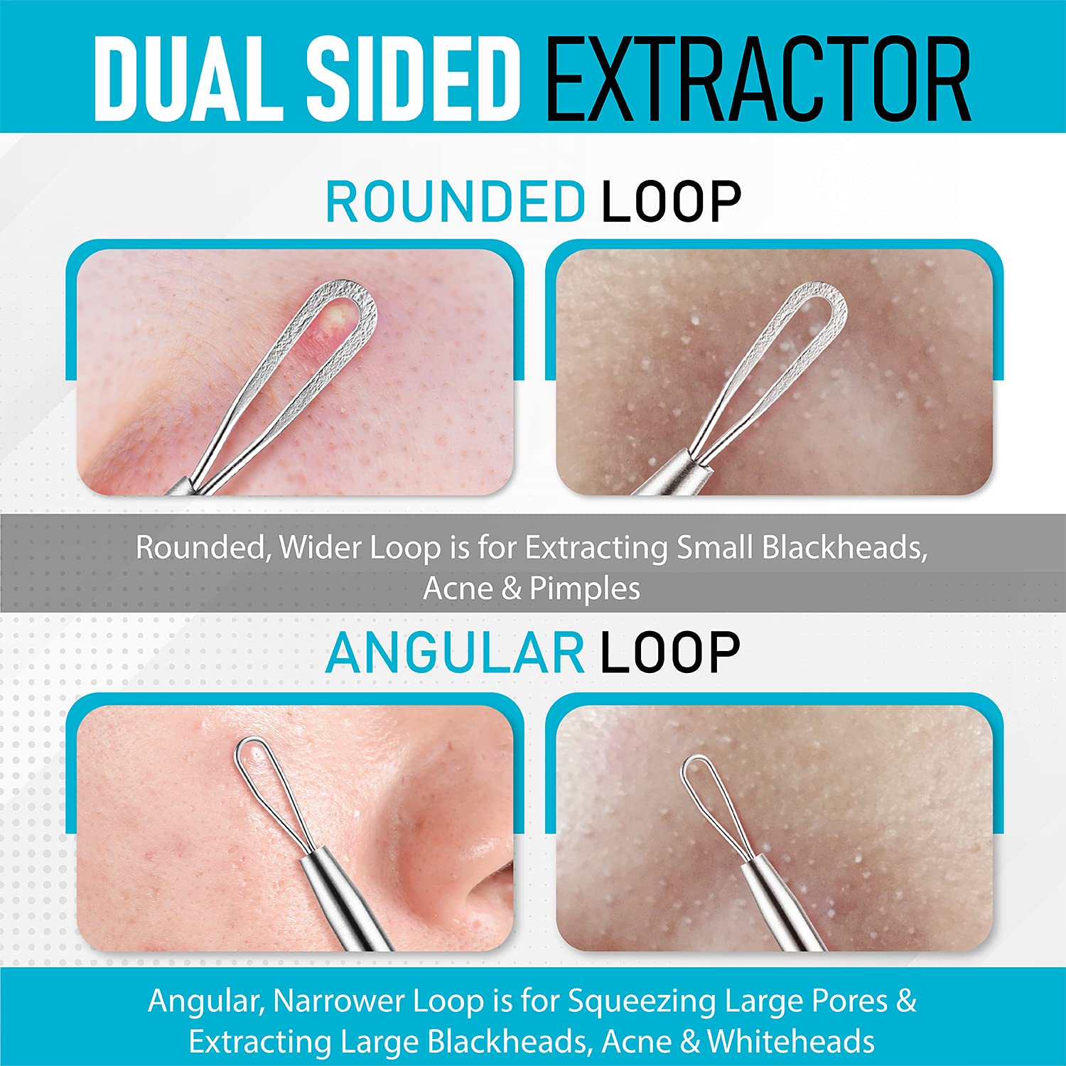Hula Home Blackhead Remover Pimple Extractor Popper Tool Acne Comedone Blackhead, Blemish, Whitehead Popping, Zit Removing for Nose Face, 304 - Stainless Steel