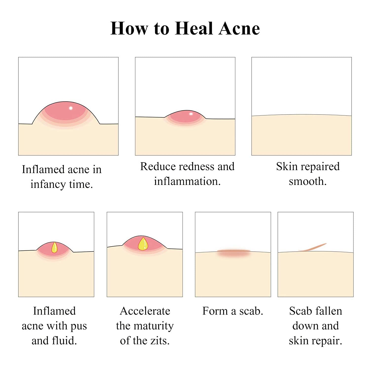BREYLEE Acne Treatment Cream, Tea Tree Oil Acne Cream for Clearing Severe Acne, Breakout, Remove Pimple and Repair Skin (20ml,0.7oz)