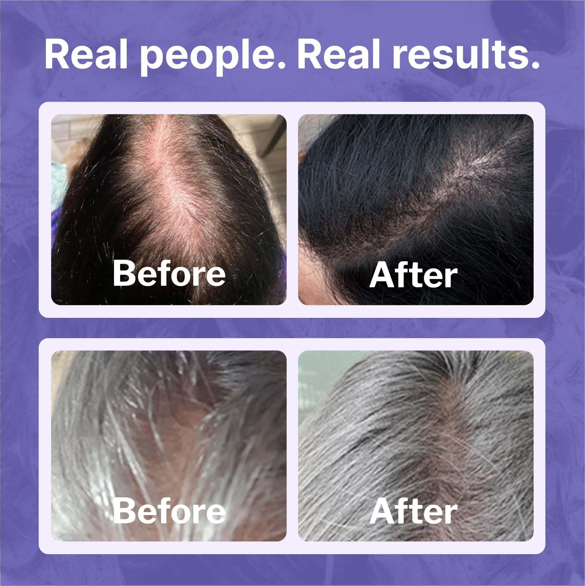 Minoxidil 2% Topical Solution for Women's Hair Growth, Serum Promotes Hair Regrowth by Reactivating Hair Follicles | Shapiro MD (1 Month)