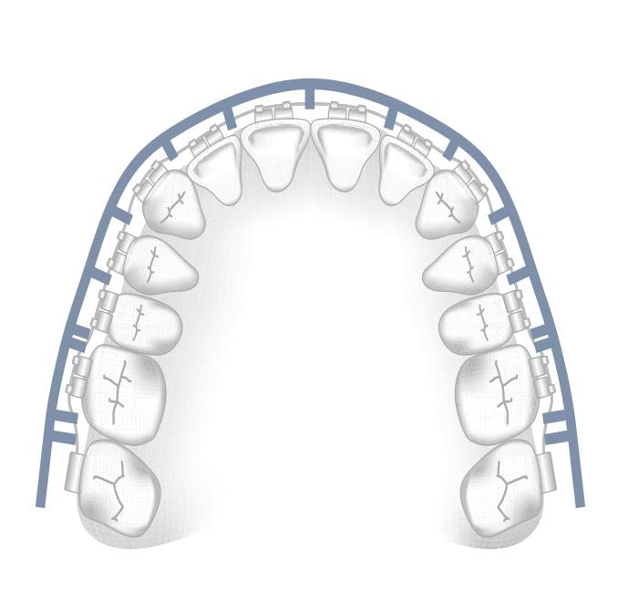 Comfort Cover for Braces, Lip Protector Mouth Guard Lip Cushion Teeth Shield Bumper for Brackets, Aligner, Dental Wax Alternative, Hard and Rigid Clip