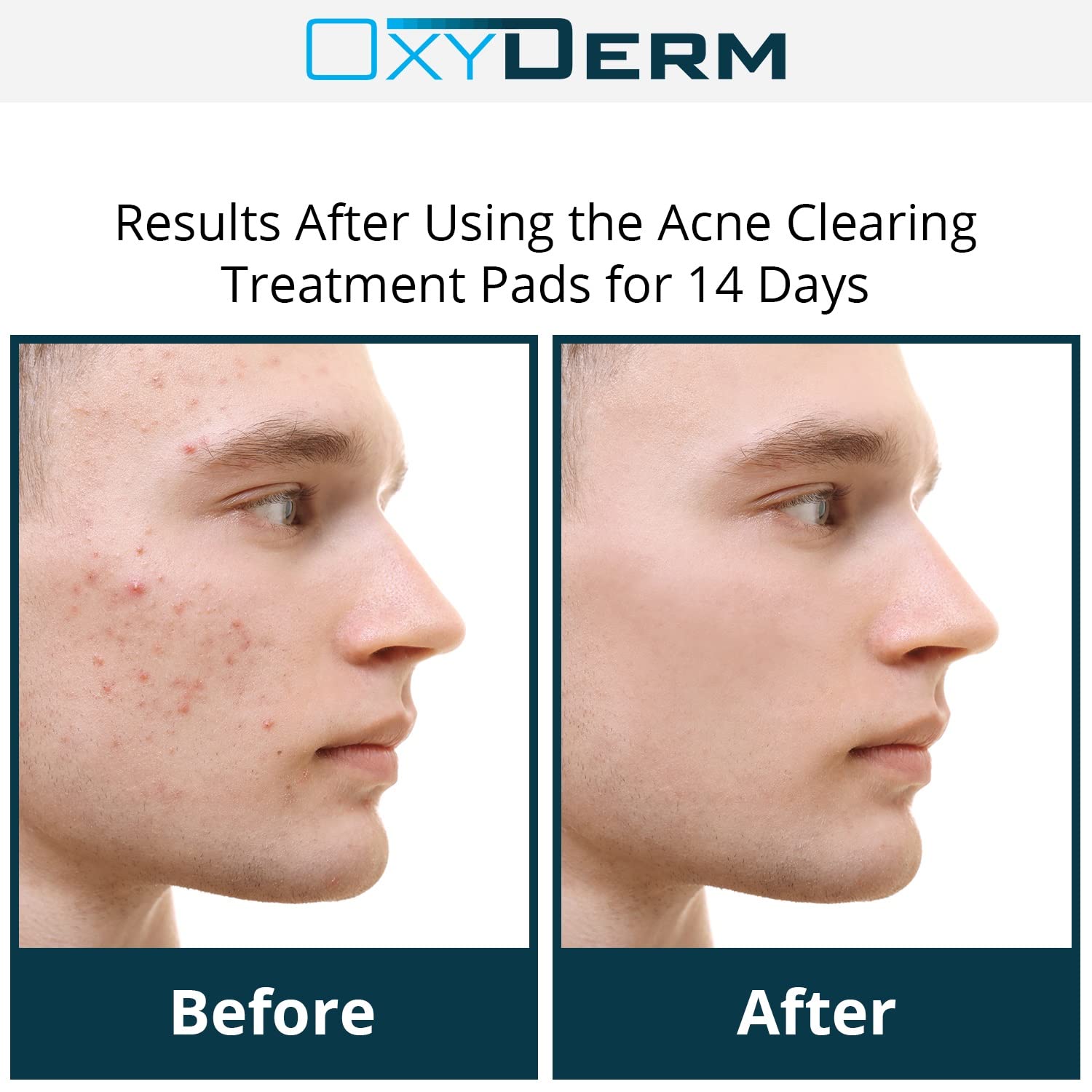 Acne Clearing Treatment Pads- Eliminates Acne Breakout Causing Bacteria. Clear Away Clogged Pores, Oily Skin, Blemish, Blackhead, Pimple, Cystic Breakouts. Contains Salicylic, Glycolic & Lactic Acid.