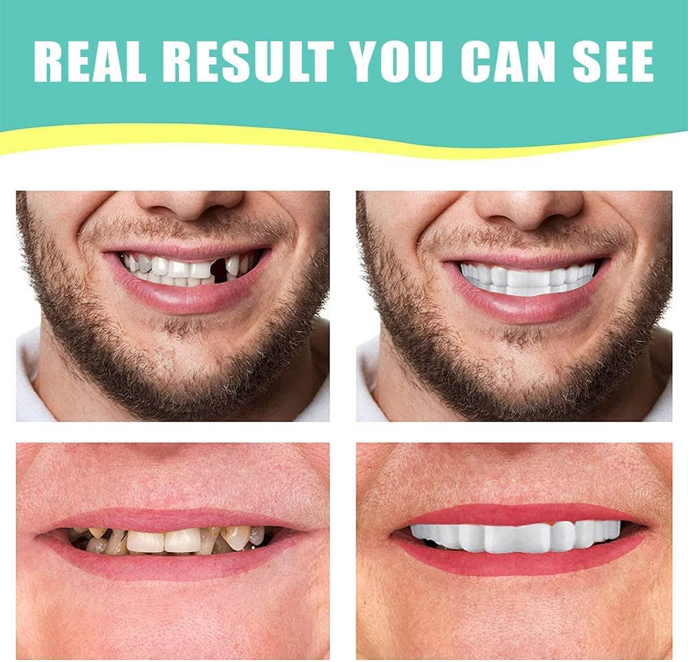1Set Dentures Veneers Tooth,Dental Care Kits for Anti Molar Orthodontic Cosmetic Teeth,Smile Snap Tooth.(White,1Top+ 1Bottom+2Adhesives+1Tweezers+1Heart-Shaped Storage Box)