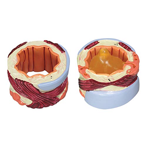 GPI Anatomicals - Anatomy Model of Human Respiratory System with Chronic Obstructive Pulmonary Disease (COPD), Bronchus and Alveoli Models for Anatomy and Physiology Education, Medical Study Supplies