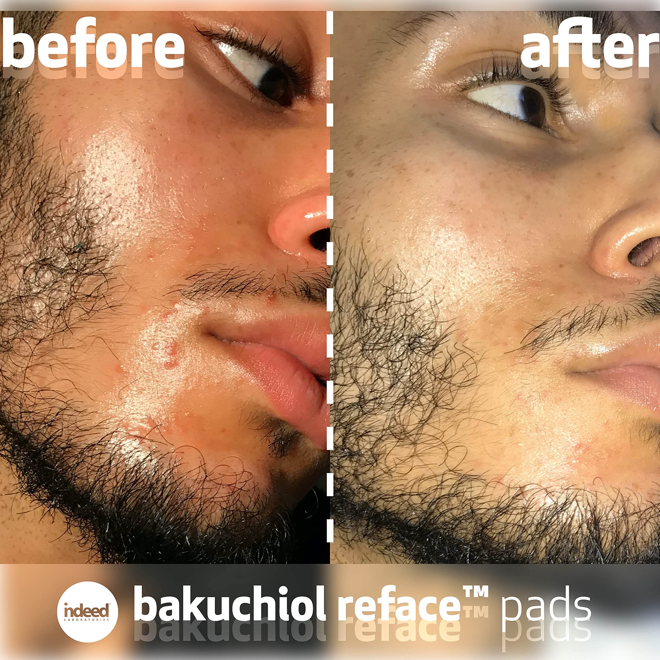 Indeed Labs Bakuchiol Reface Pads - Plant-based retinol alternative, no irritation, 5x more antioxidant. Good for acne-prone skin, sun damage, fine lines And wrinkles. 30 Pads