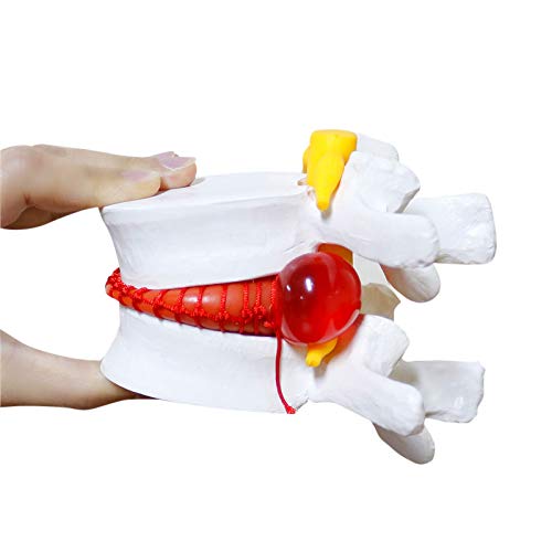 Global-Dental Anatomical Herniated Lumbar Vertebrae Disc Prolapse Model Human Anatomy Model White