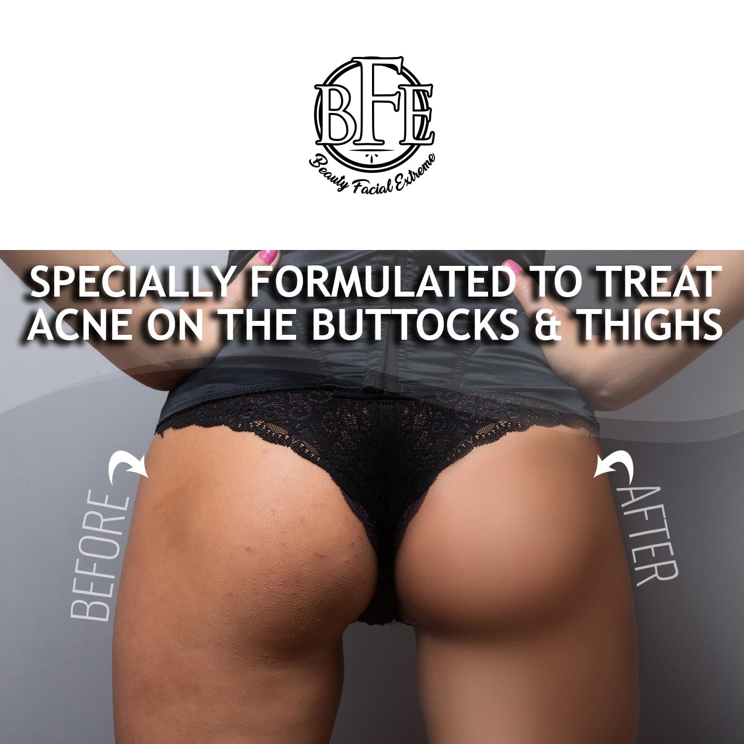 Anti-Acne Buttocks & Thigh Treatment- Clears Away Acne, Pimples, and Ingrown Hairs for the Buttocks and Thigh Area. Prevents Future Breakouts. 6.9 OZ