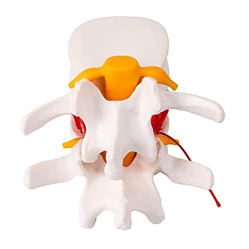Human Anatomical Lumbar Disc Herniation Model - Lumbar Spine Model for Teaching & Learning - Excellent Way for Demonstrating Disc