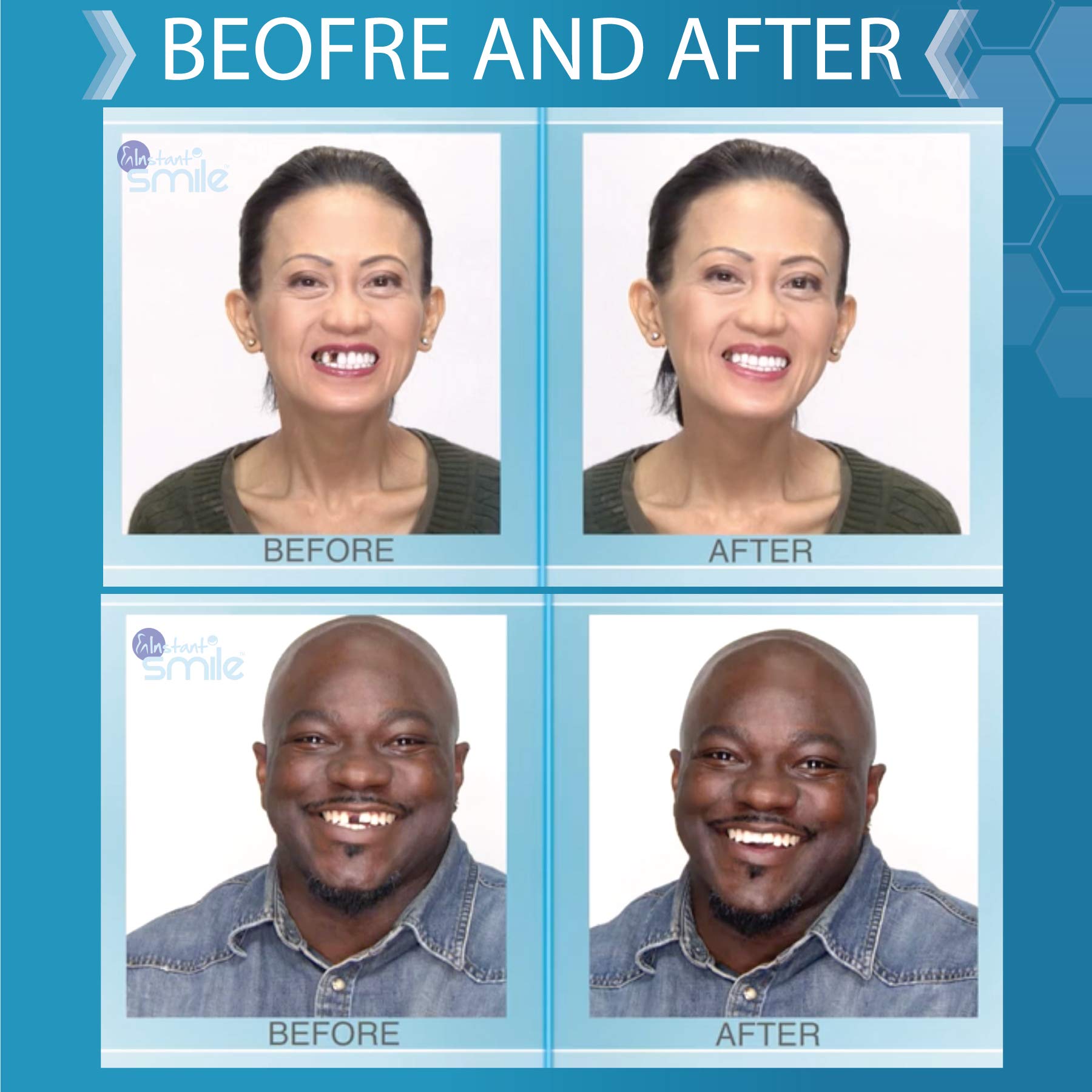 Instant Smile Complete Your Smile Tooth Replacement Kit with 3 Pack Fitting Beads