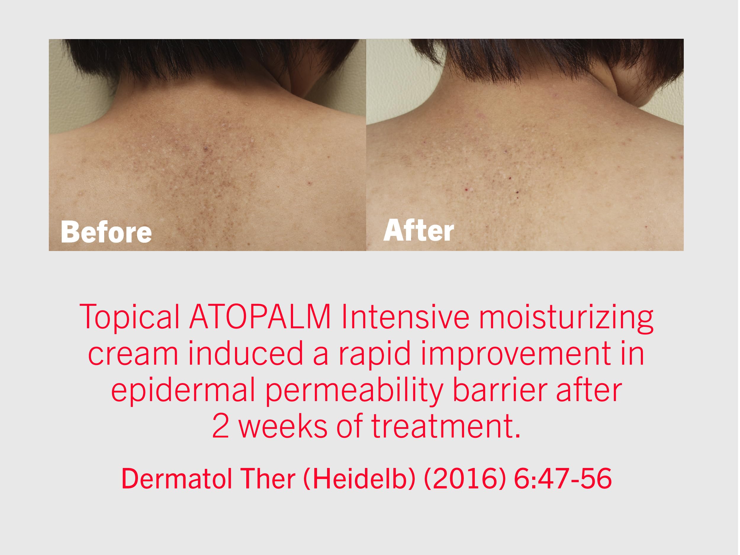 ATOPALM Intensive Moisturizing Cream for Dry & Sensitive Skin, Face Moisturizer, Replenishes Hydration, Paraben-Free, K-Beauty, skin barrier ceramide cream, 3.4 Fl Oz, 100ml (3.4 Fl Oz)
